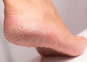 What are the Differences Between Calluses and Warts? Do Calluses and ...